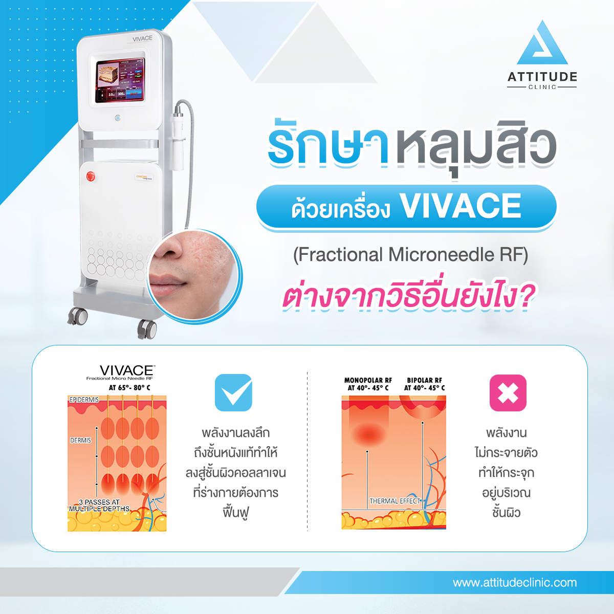 รีวิวรักษาสิวด้วยการฉายแสง ? ขั้นตอน โปรแกรม ????? ????? จำนวน ?? ครั้ง ...