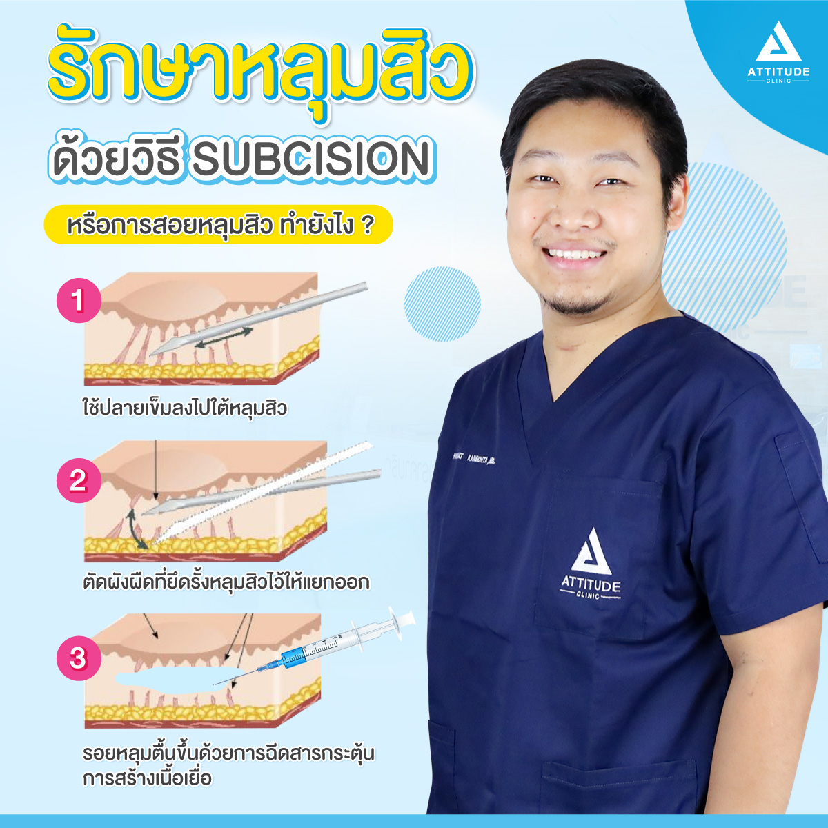 รักษาหลุมสิว ด้วยวิธี Subcision หรือ การสอยหลุมสิว ทำยังไง ? - ATTITUDE ...