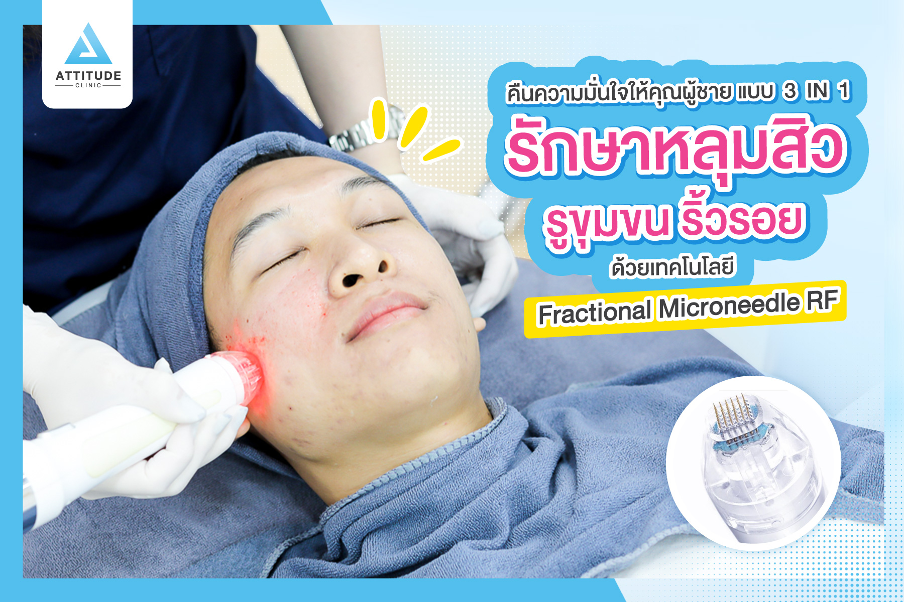รักษาหลุมสิว ด้วยเครื่อง Fractional Micro Needling RF รักษาหลุมสิว แบบ ...