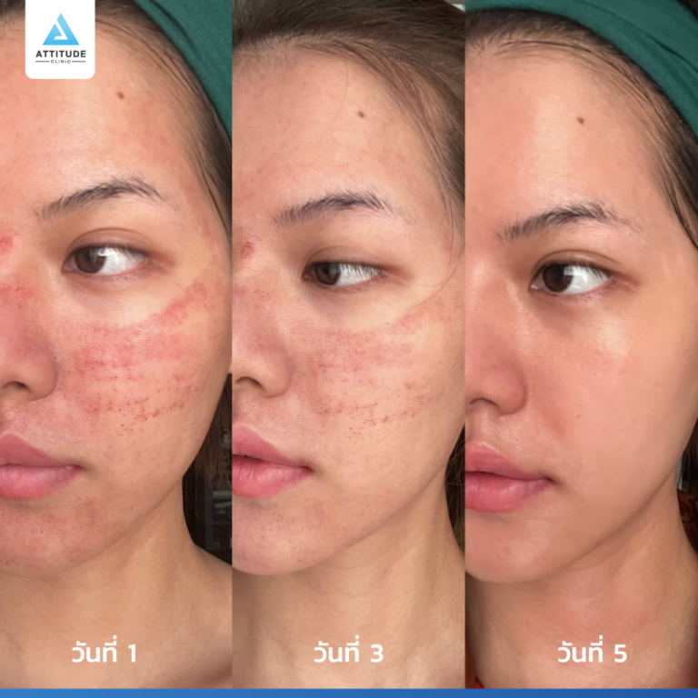 ก่อนและหลังทำเลเซอร์ PICO LASER ต้องปฏิบัติตัวอย่างไรบ้าง? ให้ผลลัพธ์ ...