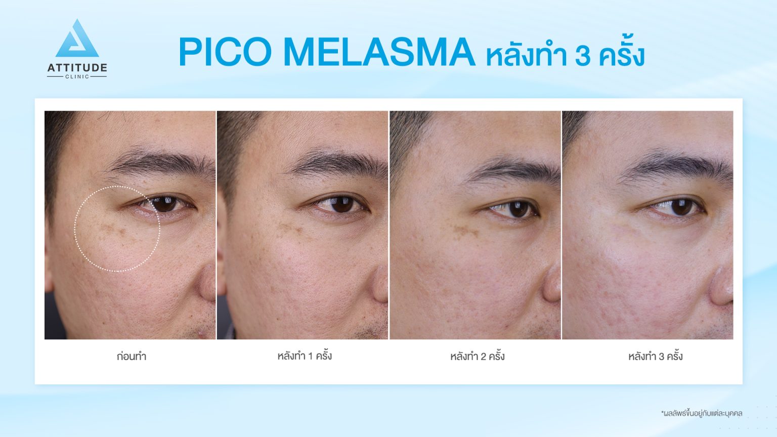 ก่อนและหลังทำเลเซอร์ PICO LASER ต้องปฏิบัติตัวอย่างไรบ้าง? ให้ผลลัพธ์ ...