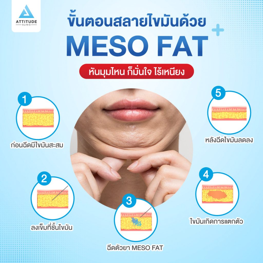 ขั้นตอนสลายไขมันด้วย Meso Fat - ATTITUDE CLINIC | คลินิกความงามคุณภาพ ...