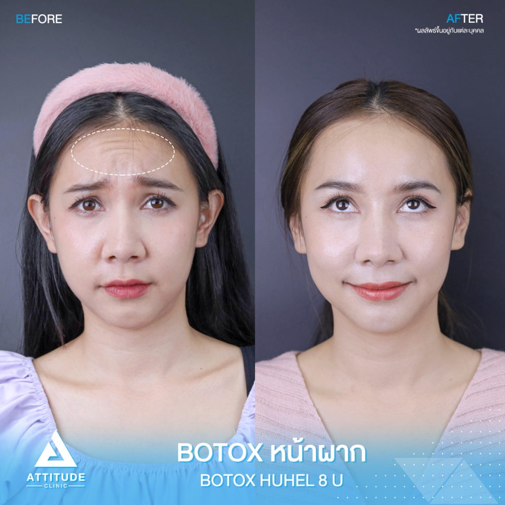 รีวิวฉีดโบท็อกซ์ลดริ้วรอย Upper Face 40 ยูนิต ด้วย โบ Hugelโบท็อกซ์ ...