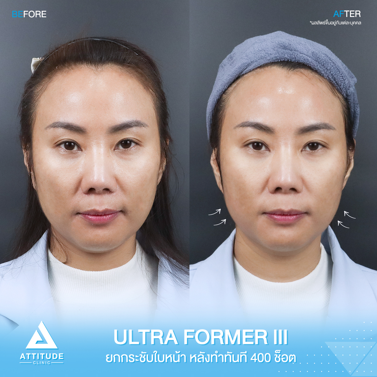 รีวิวยกกระชับใบหน้า Ultraformer III จำนวน 400 Shot ของคุณนุ้ย แก้ปัญหา ...