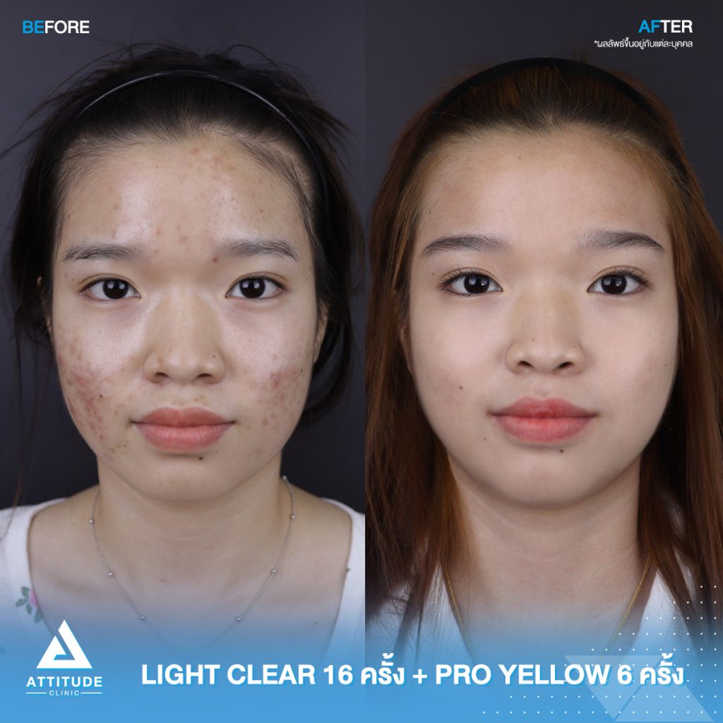 โปรบุฟเฟต์ Pro Yellow Laser เหมาๆ ไม่อั้นตลอด 6 เดือน ช่วยรักษารอยแดง ...