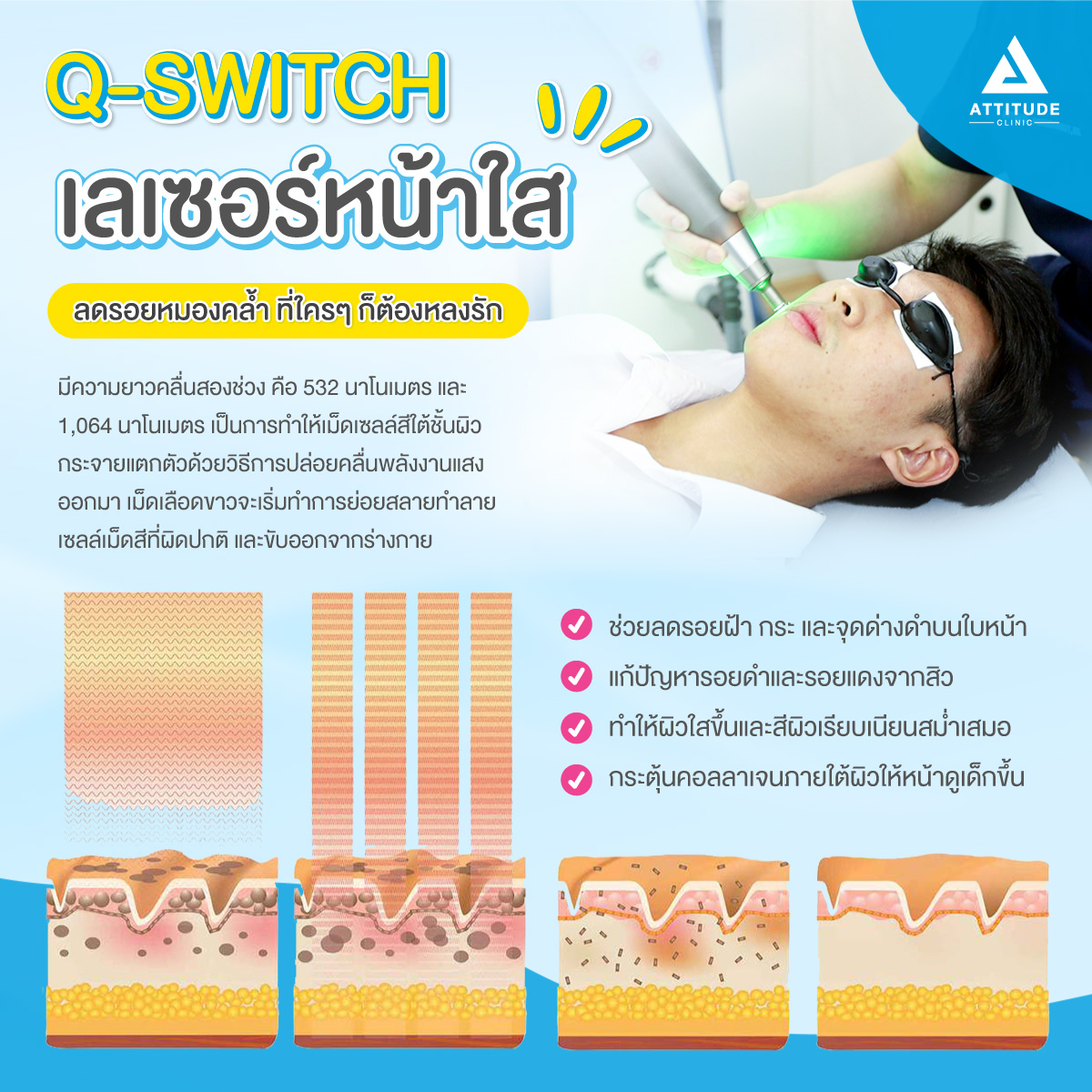 Q-Switched เลเซอร์หน้าใส ลดรอยหมองคล้ำ ที่ใคร ๆ ก็ต้องหลงรัก - ATTITUDE ...