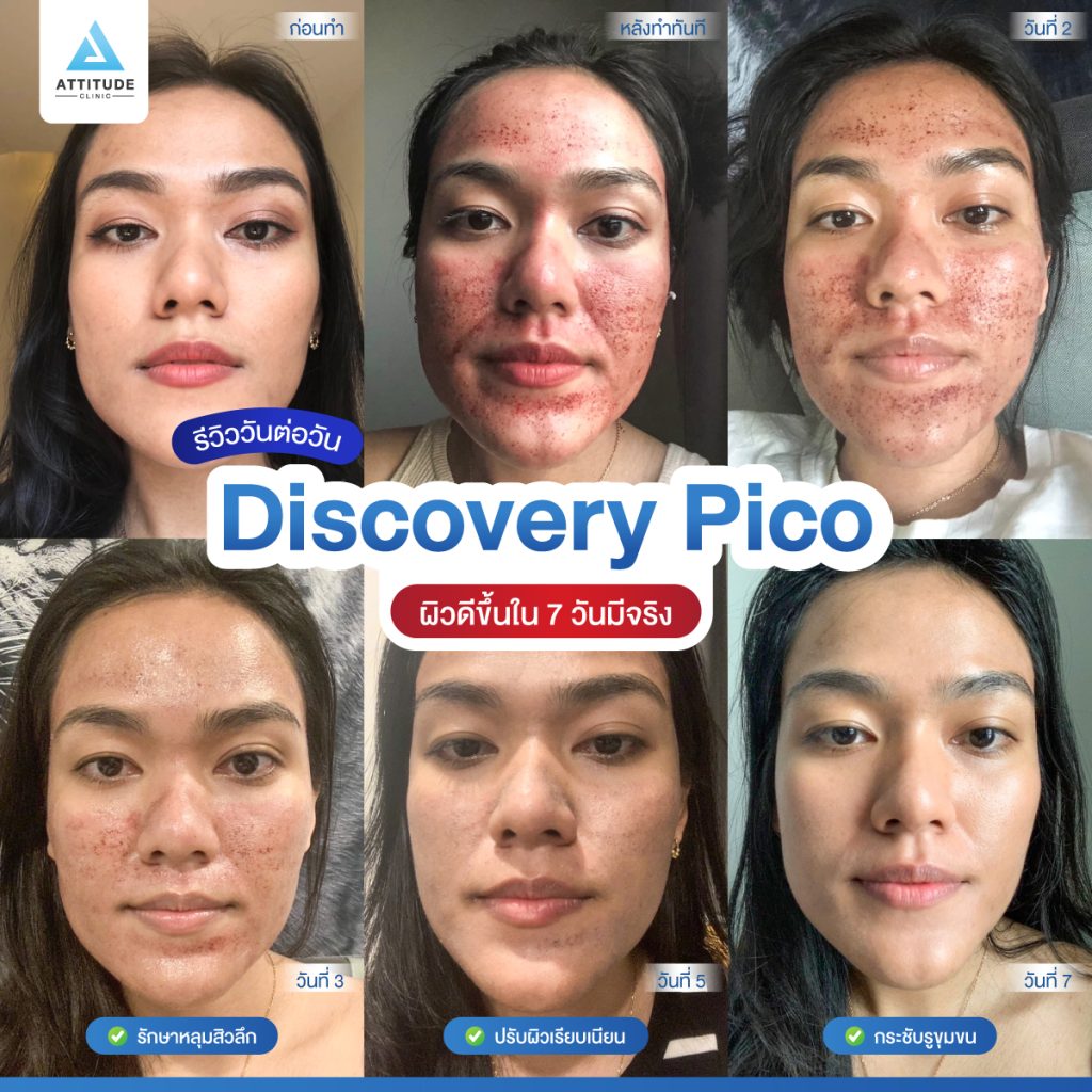 Pico Laser อะไรดี ? เทียบช็อตต่อช็อต! ทำ Pico Laser ทั้งทีต้องเลือกทำ ...