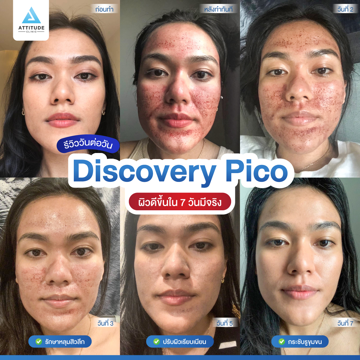 Pico Laser อะไรดี ? เทียบช็อตต่อช็อต! ทำ Pico Laser ทั้งทีต้องเลือกทำ ...