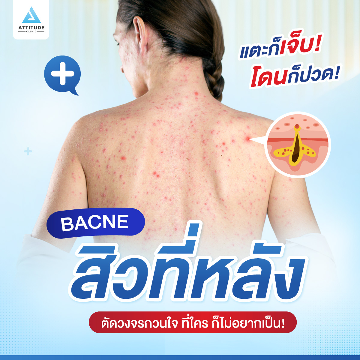 แตะก็เจ็บ โดนก็ปวด BACNE สิวที่หลัง ตัดวงจรกวนใจที่ใคร ก็ไม่อยากเป็น ...