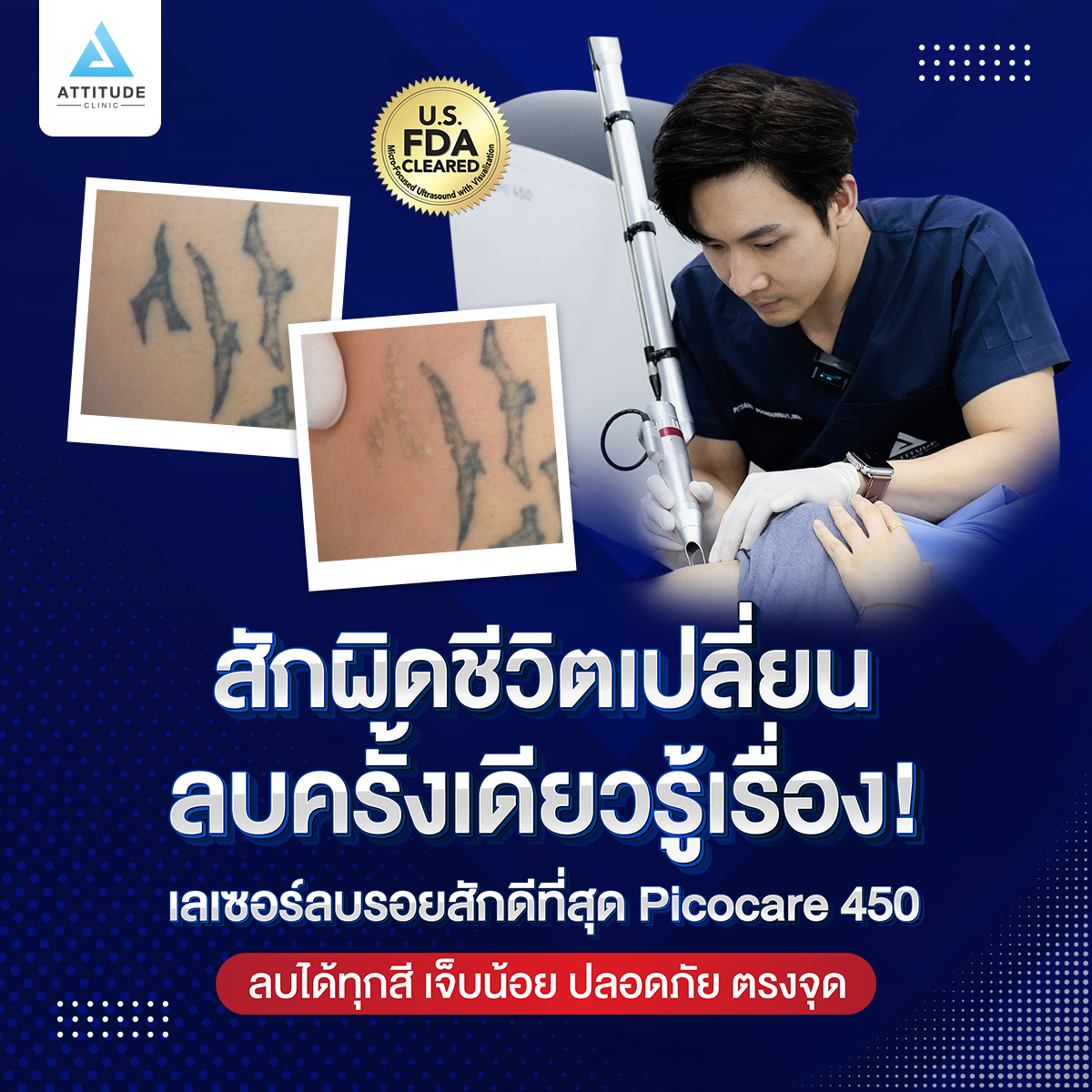 Picocare 450 เทคโนโลยี Picosecond Laser เลเซอร์ลบรอยสักดีที่สุด ลบได้ ...