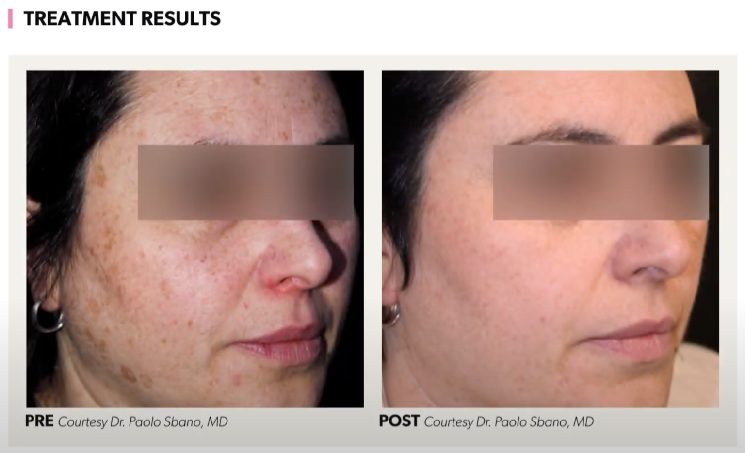 Discovery PICO ใหม่ล่าสุด! รักษาได้ทุกปัญหาผิว เทคโนโลยี Picosecond ...