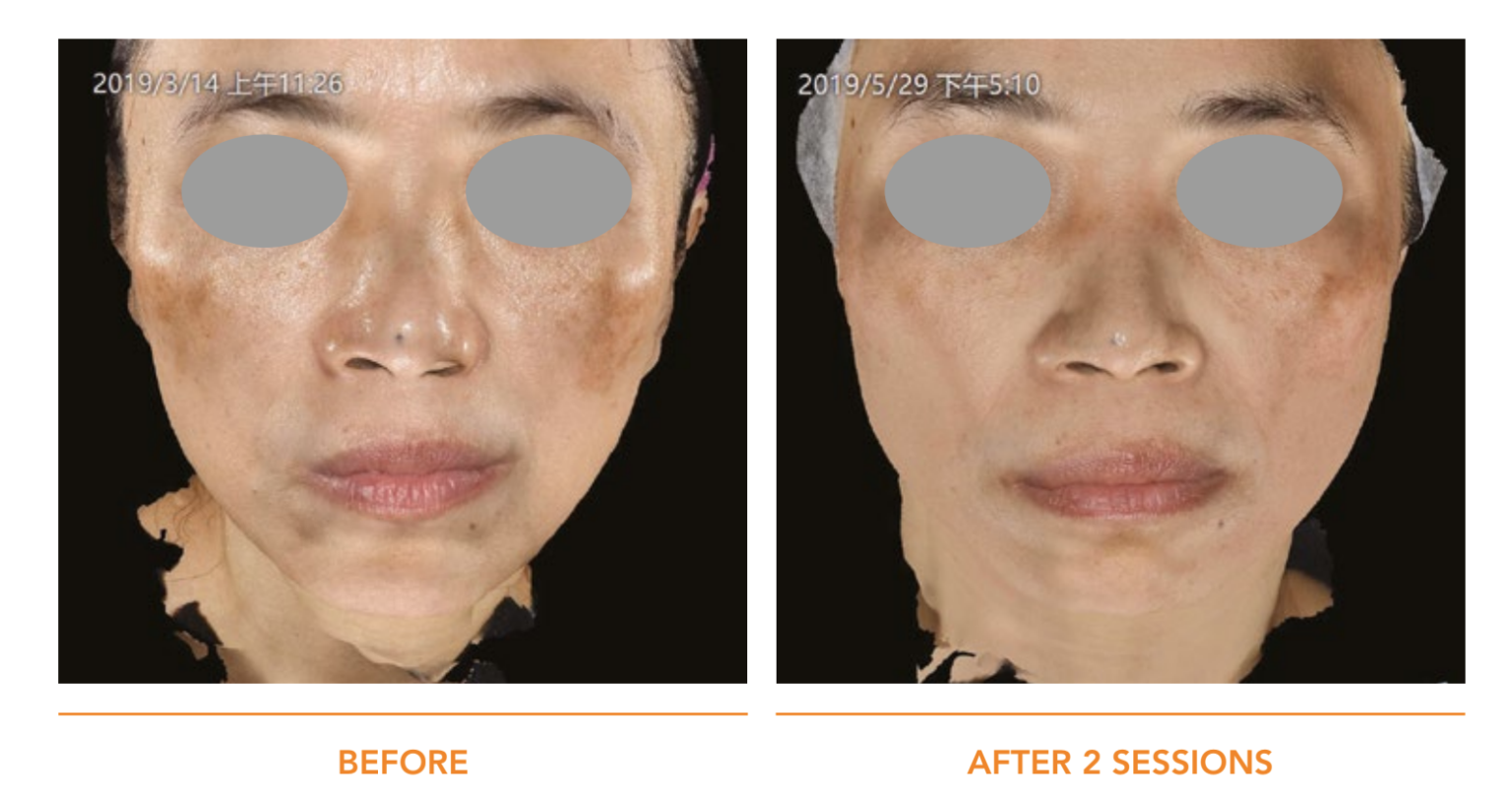 Discovery PICO ใหม่ล่าสุด! รักษาได้ทุกปัญหาผิว เทคโนโลยี Picosecond ...