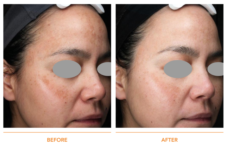 Discovery PICO ใหม่ล่าสุด! รักษาได้ทุกปัญหาผิว เทคโนโลยี Picosecond ...