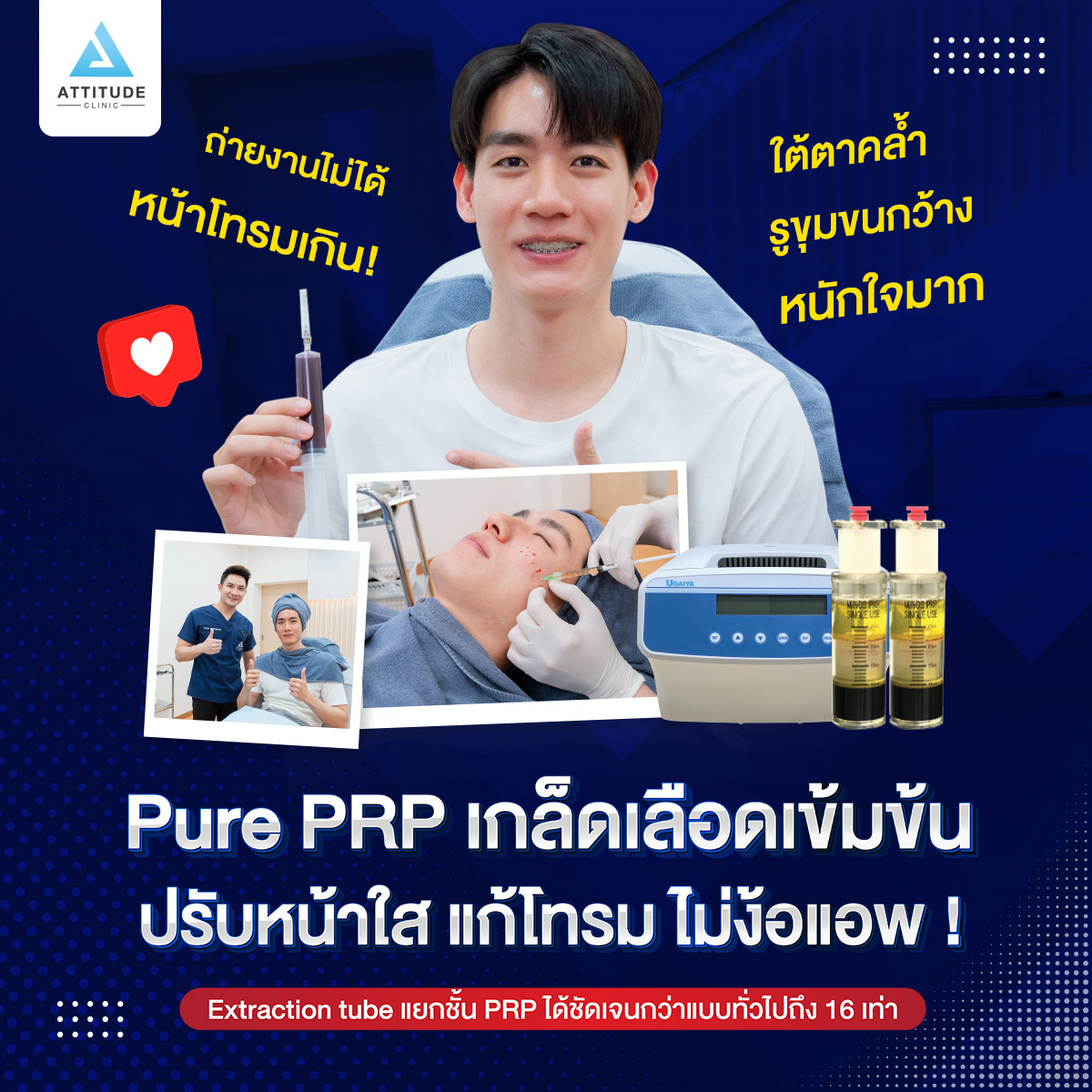 Pure PRP เกล็ดเลือดเข้มข้น หน้าใส รอยคล้ำใต้ตา กระชับรูขุมขน กระตุ้น ...