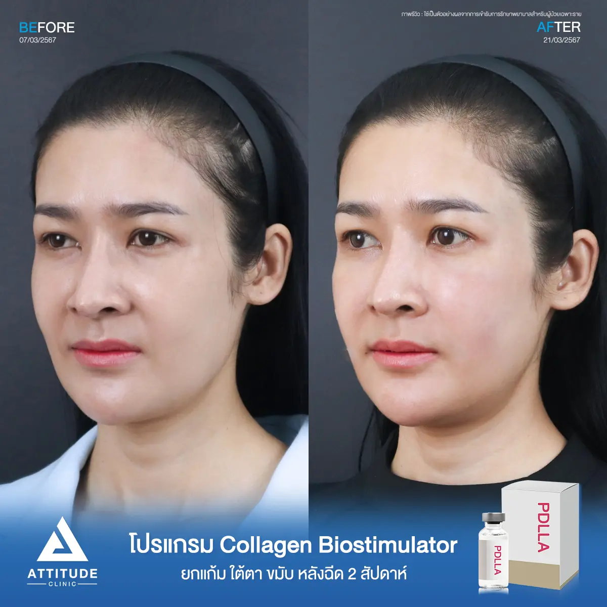 รีวิวโปรแกรมฉีด Collagen Biostimulator ,PDLLA เติมเต็มร่องลึก