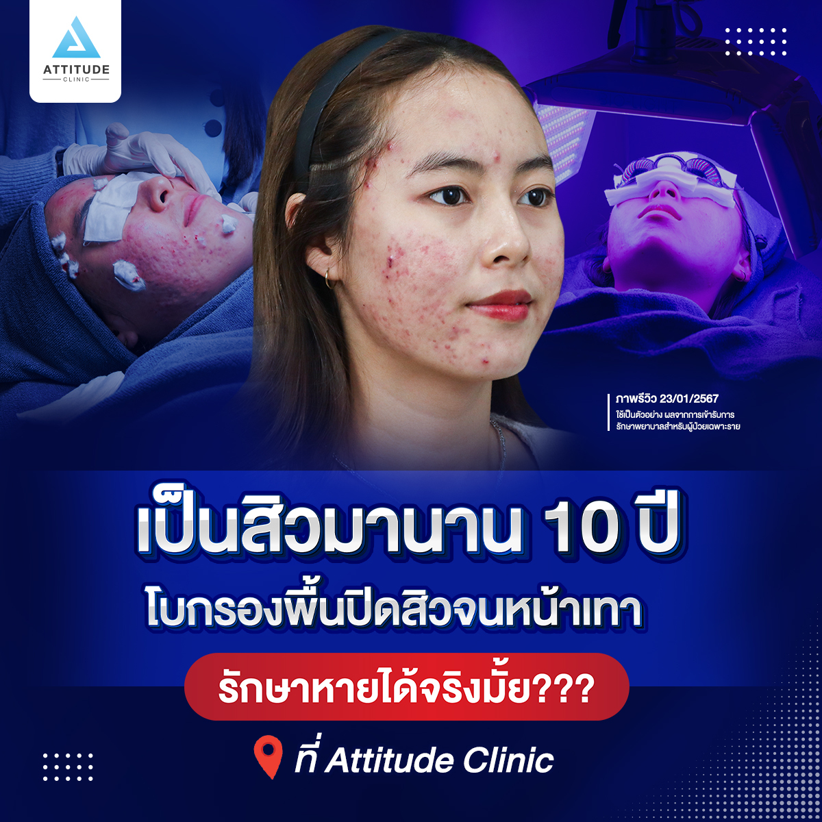 เป็นสิวนานกว่า 10 ปี มารักษาจนหายได้ใน 10 ครั้ง ที่ Attitude Clinic - ATTITUDE CLINIC | คลินิก ...