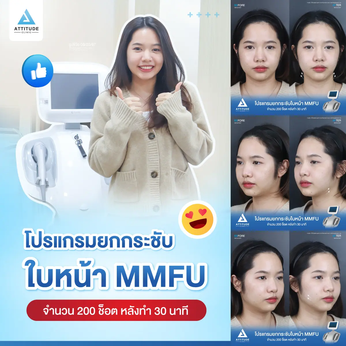 รีวิวโปรแกรมยกกระชับใบหน้า MMFU คุณแป้งร่ำ จำนวน 200 ช็อต หลังทำ 30 นาที ยกกระชับผิว และสลาย ...
